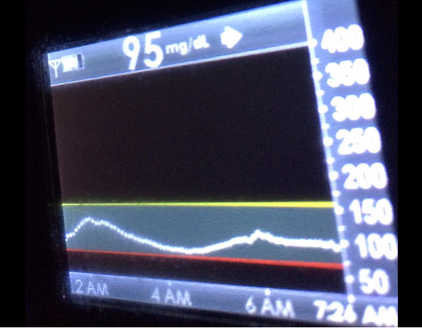 How Does A Closed Loop Artificial Pancreas Work When You Diy Or Diyps Closed Loop Is Working
